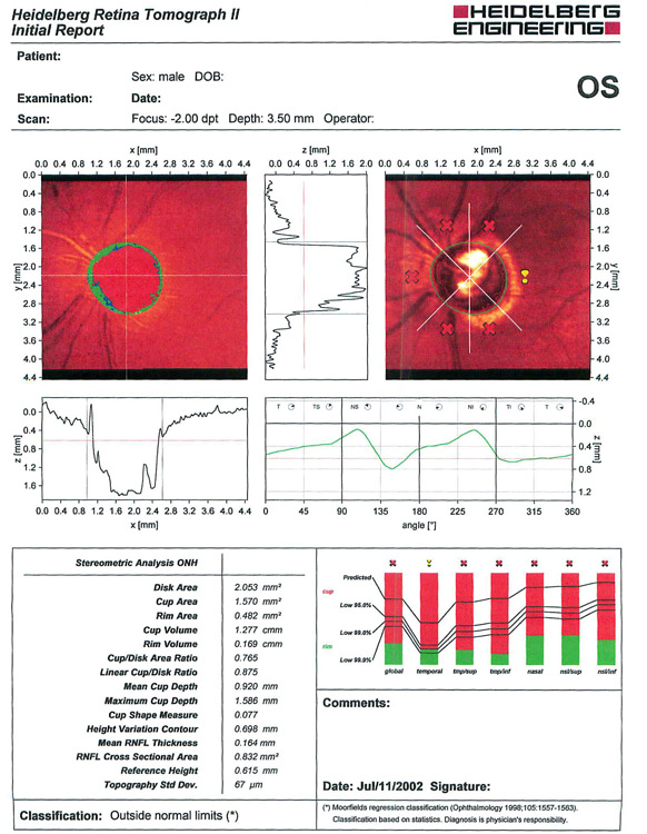 Heidelburg (SP) HRT II - Fab Eye Care