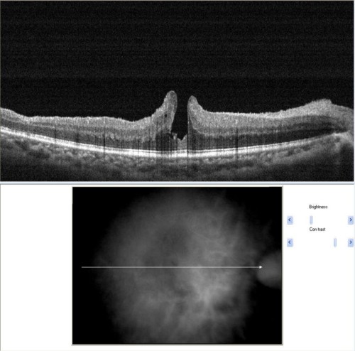 Optovue – RTVue SD-OCT