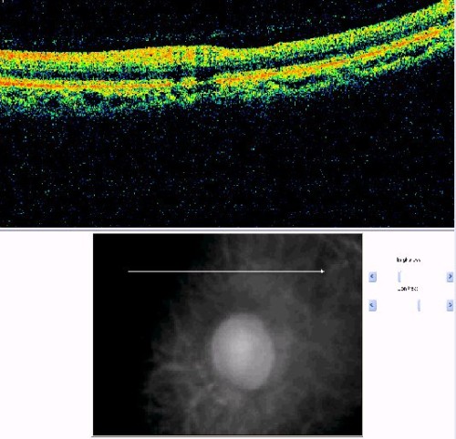 Optovue – RTVue SD-OCT