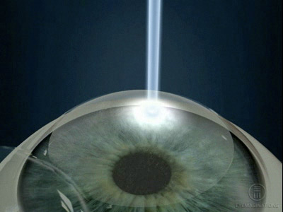 Customized LASIK, Epi-LASIK, PRK, PTK