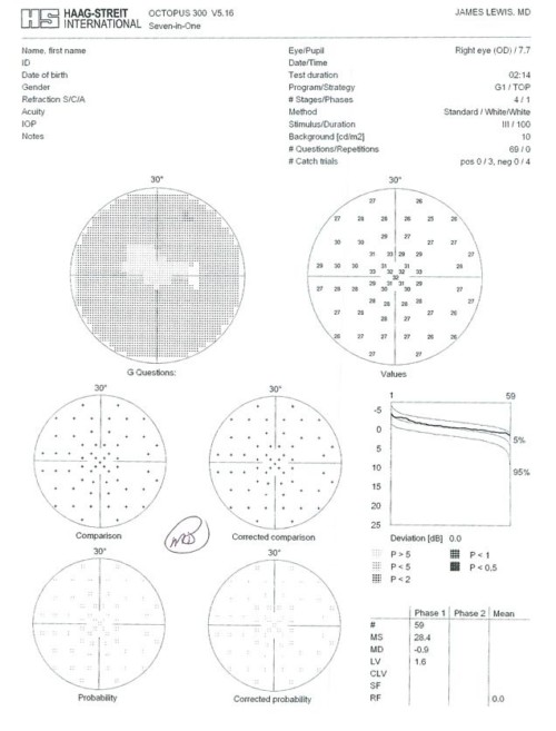 Humphrey Visual Field - Fab Eye Care
