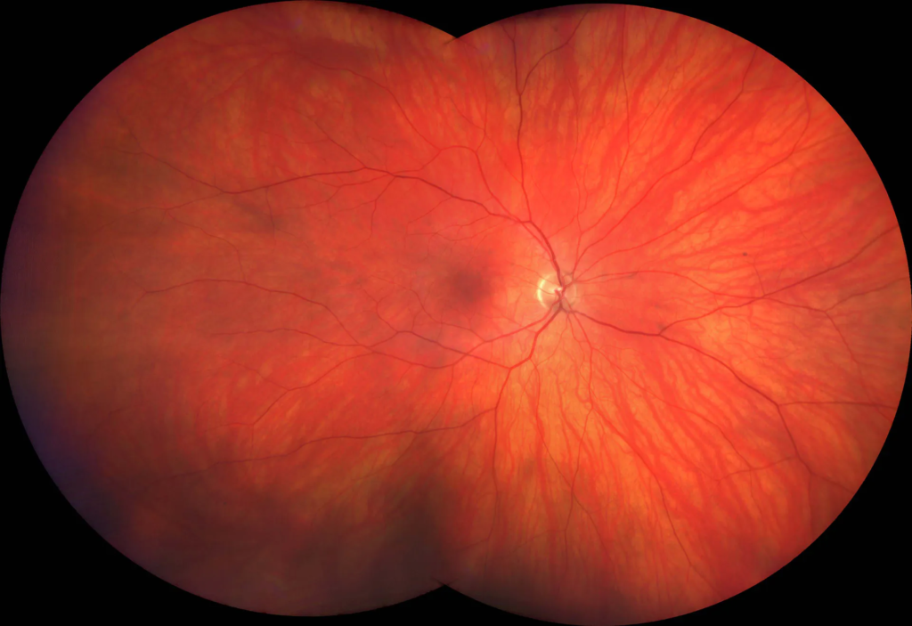 Clarus 500 - Fab Eye Care