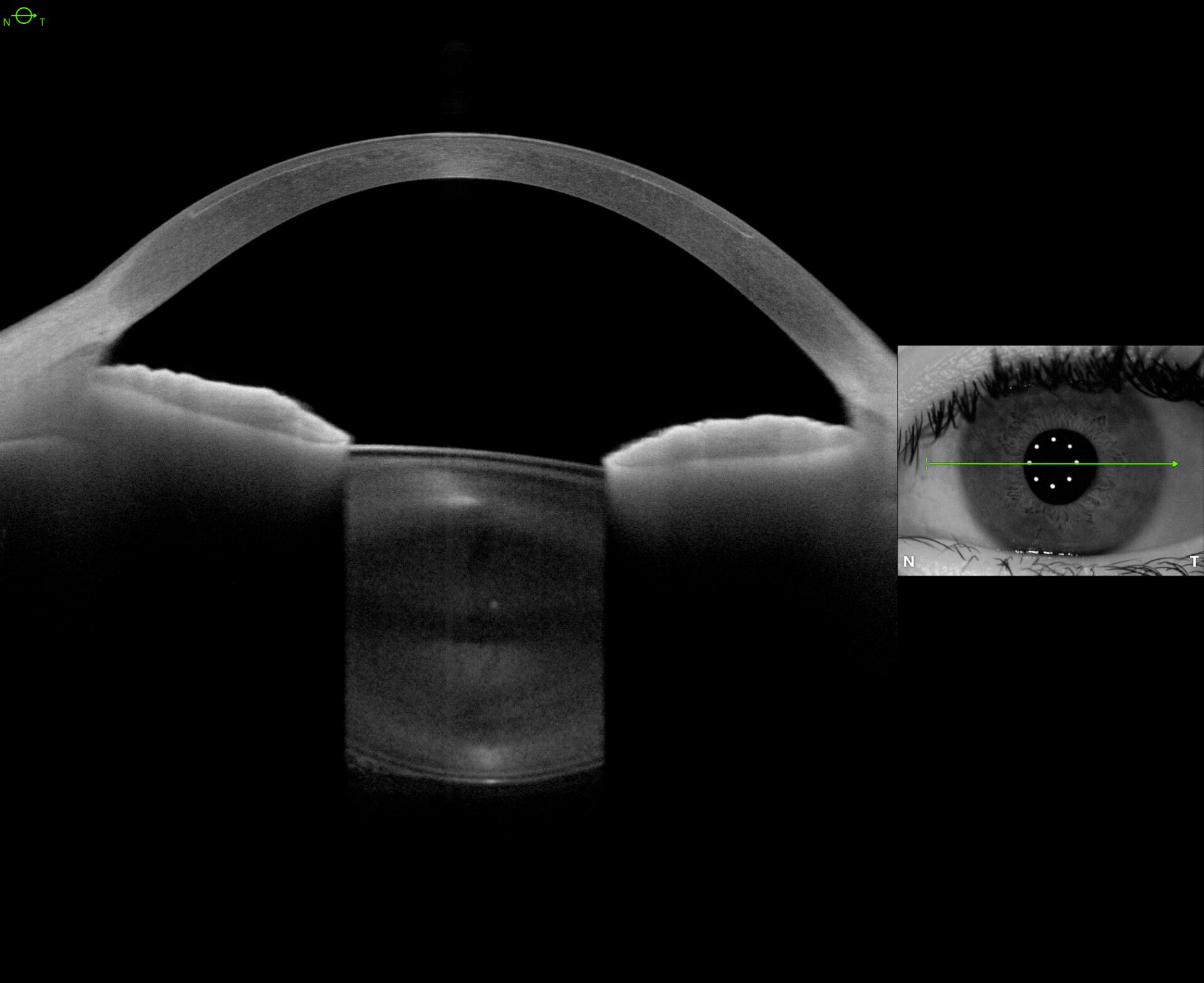 Ziemer Z4 femtosecond laser Bladeless LASIK - Fab Eye Care