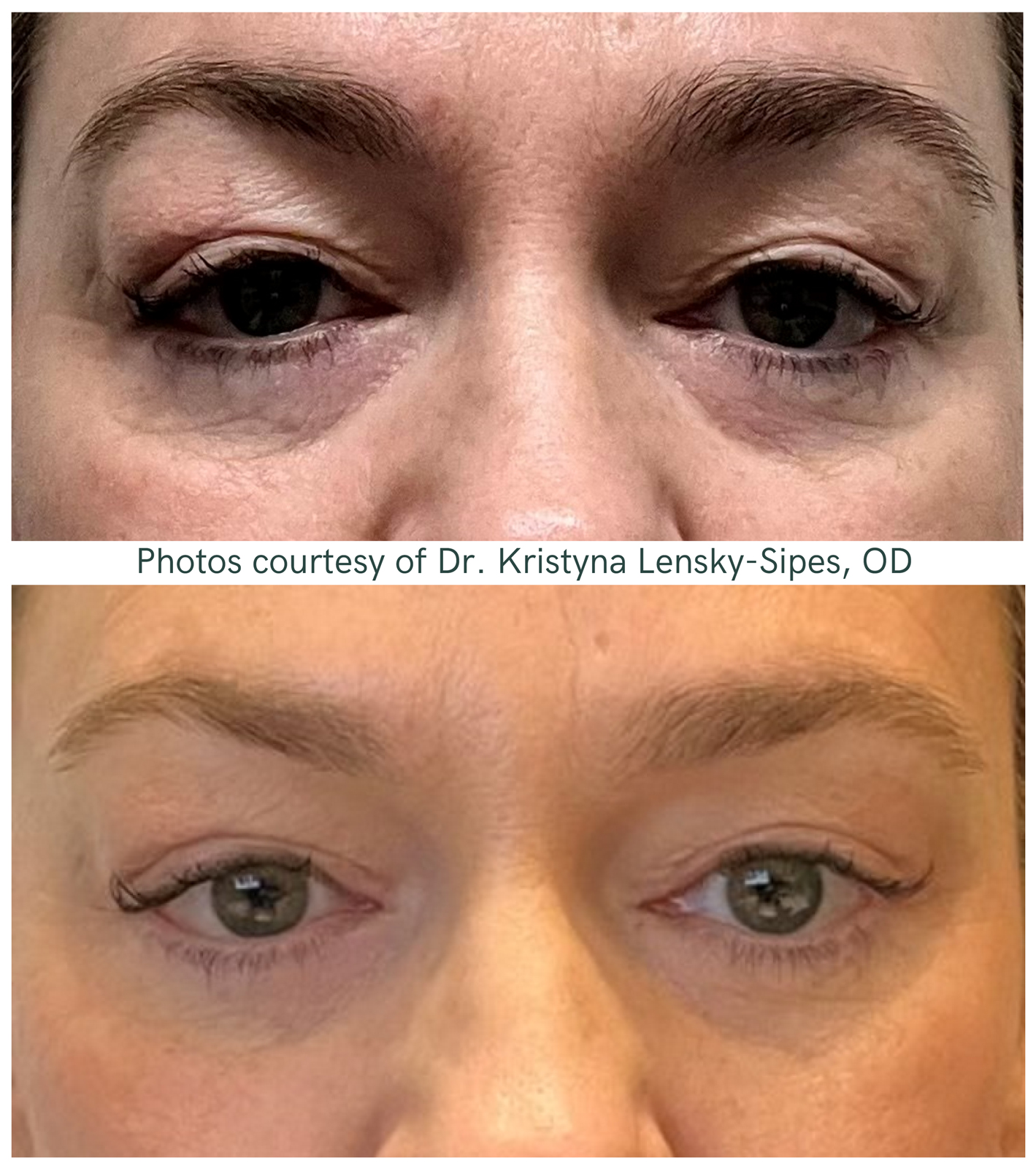 Lumenis OptiPLUS RF for Dry Eye Relief - Fab Eye Care